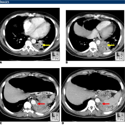 Pulmonary Sequestration | Radiology Notes
