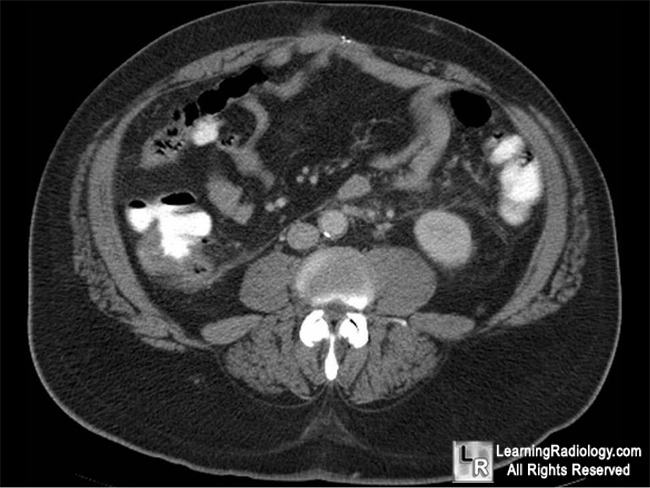 LearningRadiology - Typhlitis, Neutropenic, Enterocolitis, ileum, cecum ...