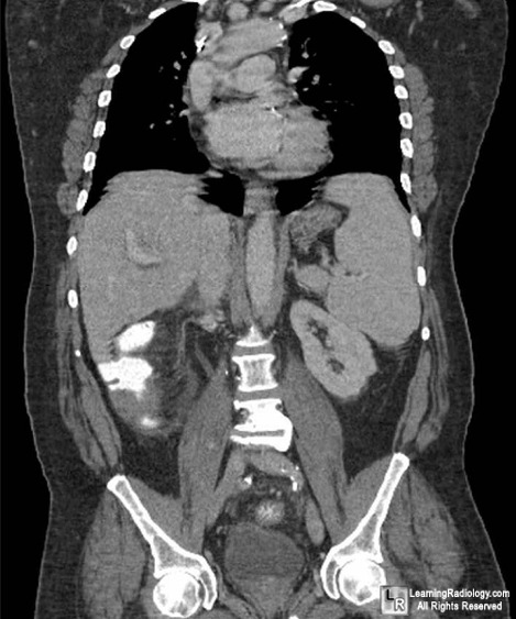 LearningRadiology - Typhlitis, Neutropenic, Enterocolitis, ileum, cecum ...