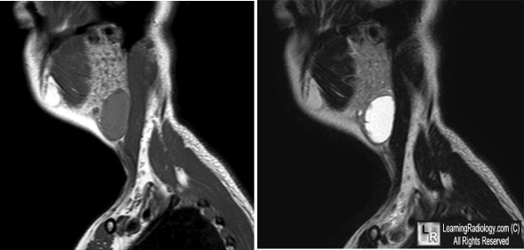 LearningRadiology - branchial, cleft, cyst, 2nd, 2, second, II, ct ...