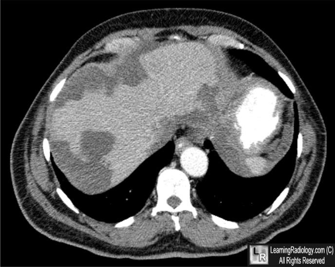 LearningRadiology - Pseudomyxoma Peritonei