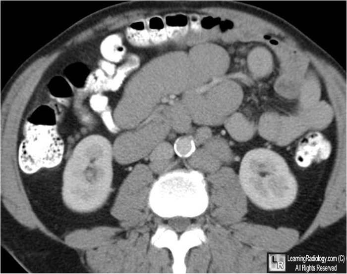 LearningRadiology - sandwich, sign, hamburger, mesenteric, lymphoma, ct ...