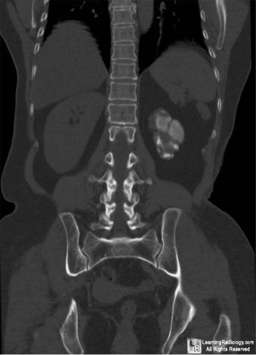 LearningRadiology - renal, tuberculosis, kidney, tb