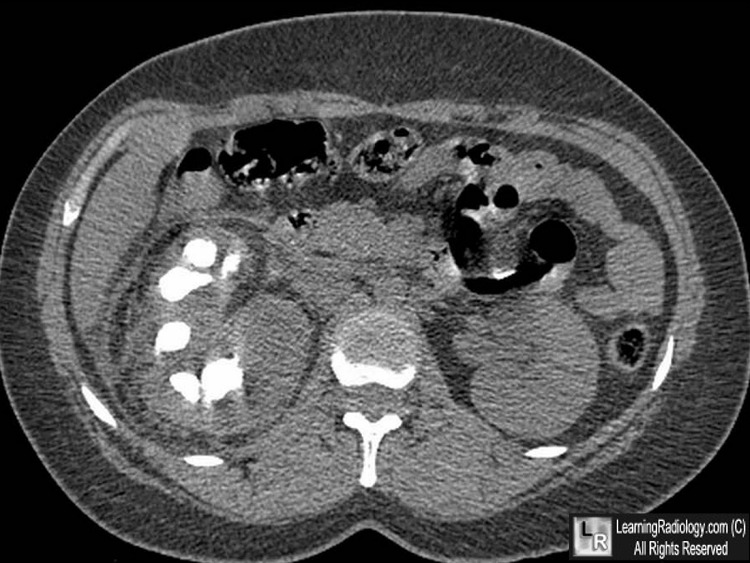LearningRadiology - Xanthogranulomatous, Pyelonephritis, XGPN ...