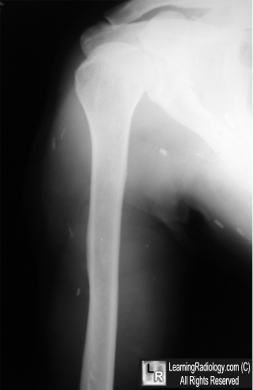 LearningRadiology - Neurocysticercosis, cysticercosis, brain, muscle ...