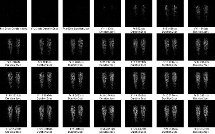 LearningRadiology - shin, splints, medial, tibial, stress, syndrome ...