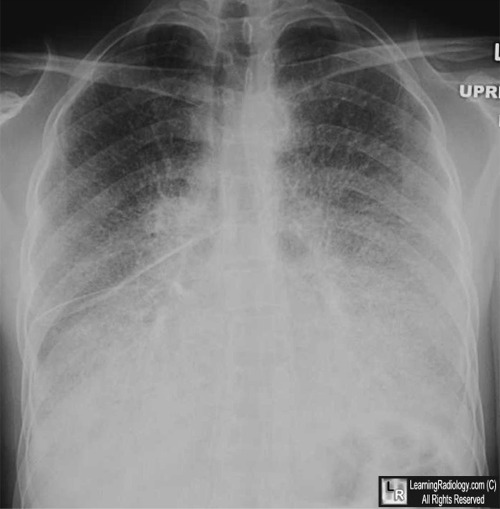 LearningRadiology - Pulmonary, Alveolar, Microlithiasis