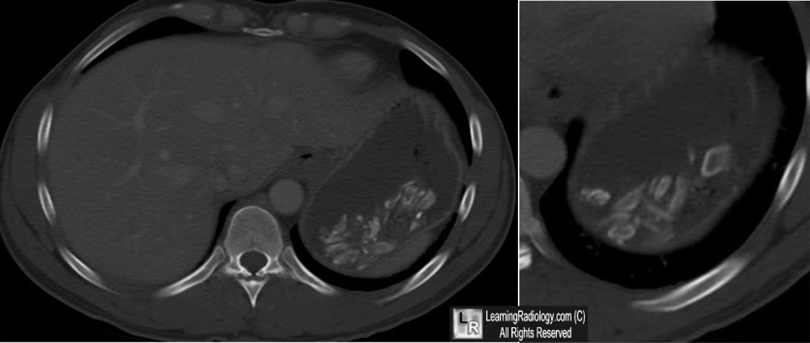 LearningRadiology - Ingested, Neck, Bones, Visualization, CT, stomach ...