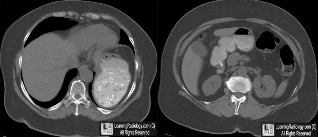 LearningRadiology - Ingested, Neck, Bones, Visualization, CT, stomach ...