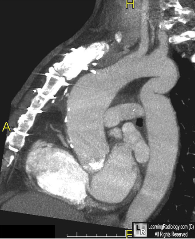 LearningRadiology - Pseudocoarctation, Aorta