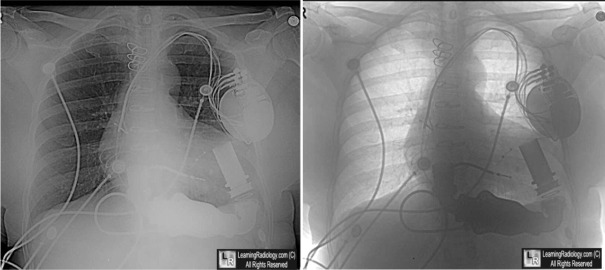 LearningRadiology - Left, Ventricular, Assist, Device, LVAD, heartmate ...