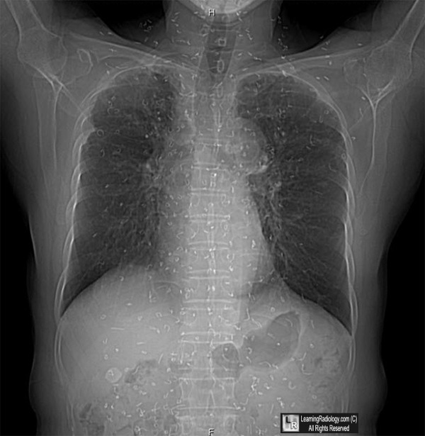 LearningRadiology - Acupuncture, Needles
