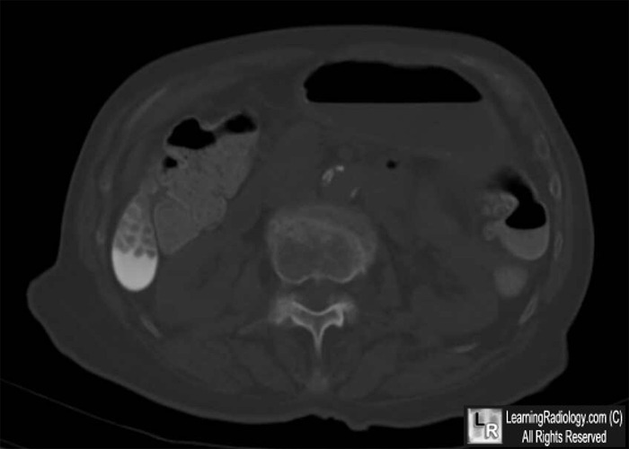 LearningRadiology - milk, calcium, bile
