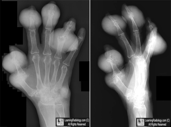 LearningRadiology - gout, hand, gouty, arthritis, finger, xray, x-ray ...