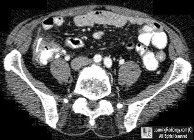 LearningRadiology - Foreign, Body, Chicken, Bone, Perforation, Bowel ...