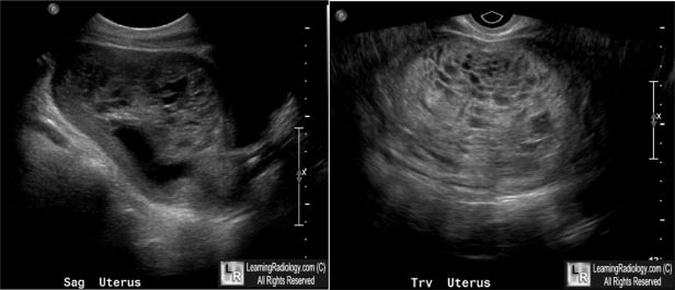 LearningRadiology - Hydatidiform, Mole, molar, pregnancy, ultrasound ...