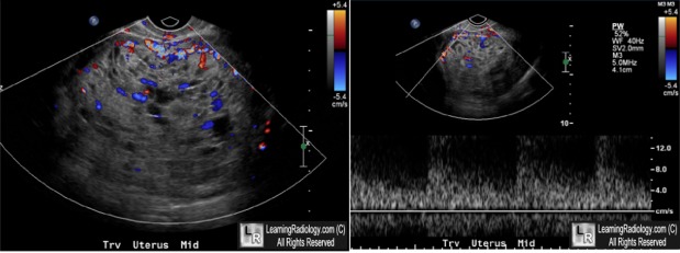 LearningRadiology - Hydatidiform, Mole, molar, pregnancy, ultrasound ...