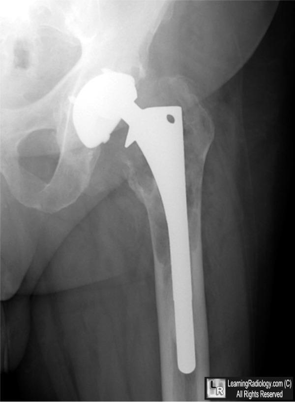 LearningRadiology - particle, disease, loosening, prosthesis, hip, knee ...