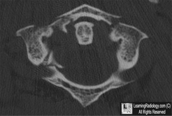 LearningRadiology - Jefferson Fracture, C2, atlas, axis
