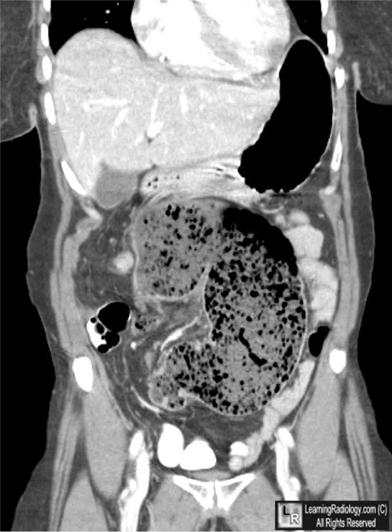 LearningRadiology - Cecal Volvulus, volvulous, cecum