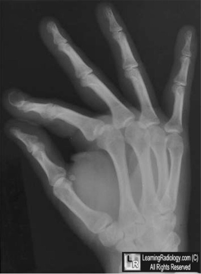 LearningRadiology - Epidermal, Inclusion, Cyst, epidermoid