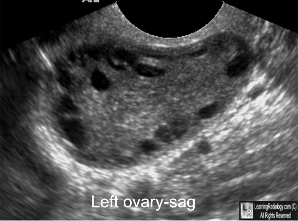 LearningRadiology - Polycystic, Ovary, Syndrome, PCOS, Stein-Leventhal ...