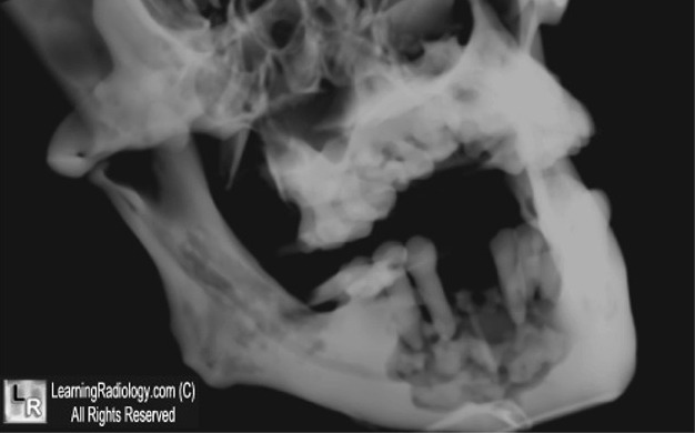 LearningRadiology - Bisphosphonate-related Osteonecrosis, Jaw, mandible ...