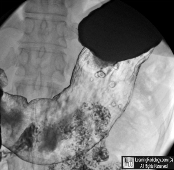 LearningRadiology - gastric, polyp, inflammatory, stomach, mucosa ...