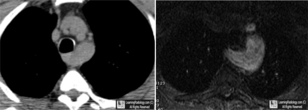 LearningRadiology - Aortic Arch Anomalies, anomlies, ANOMALOUS, RIGHT ...