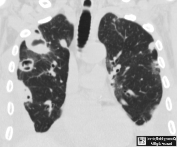 LearningRadiology - Septic, Pulmonary Emboli, embolus, embolism