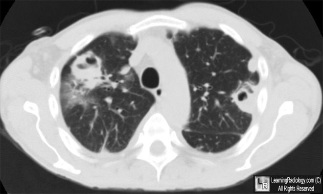 LearningRadiology - Septic, Pulmonary Emboli, embolus, embolism