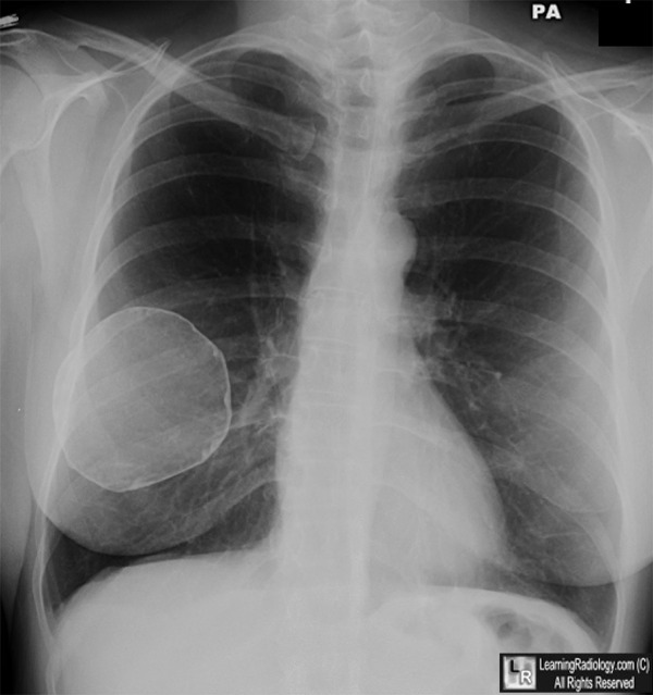 LearningRadiology - Saline Breast Implant Calcification