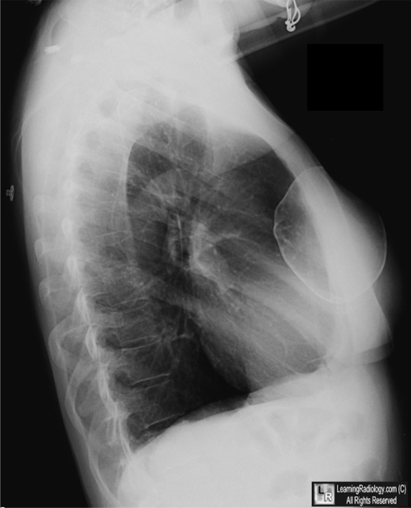 LearningRadiology - Saline, Breast, Implant, Calcification, radiology ...