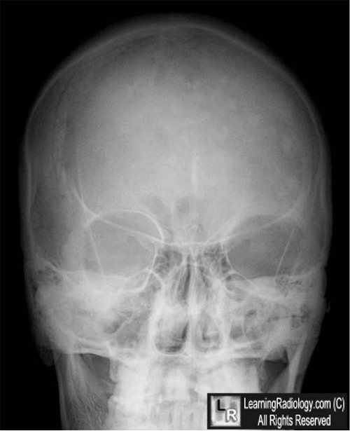 LearningRadiology - Paget, Disease, Osteoporosis, Circumscripta, skull ...