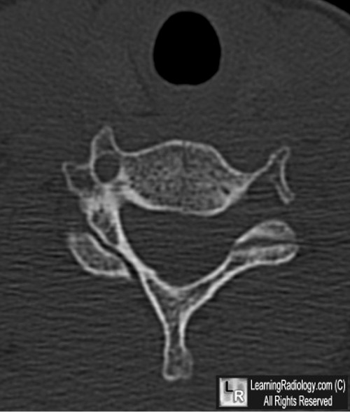 LearningRadiology - Unilateral, Bilateral, Locked, Facets, cervical ...