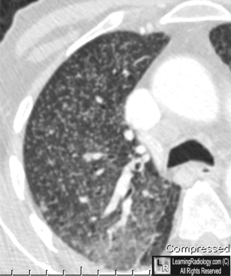 LearningRadiology - Miliary, Tuberculosis, TB