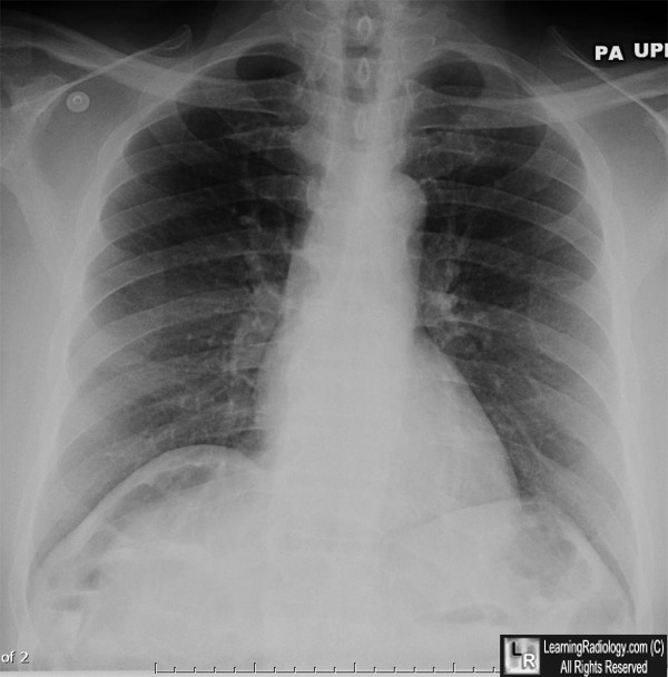 LearningRadiology - Chilaiditi Syndrome, Hepatodiaphragmatic ...