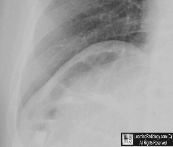 LearningRadiology - Chilaiditi Syndrome