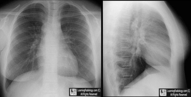 LearningRadiology - Interruption, Inferior, Vena, Cava, IVC, Azygos ...