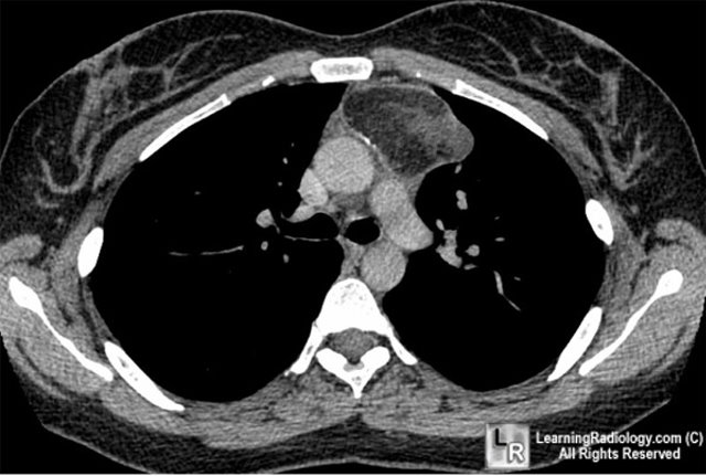 LearningRadiology - Mediastinal, Teratoma, dermoid, thorax, thoracic ...