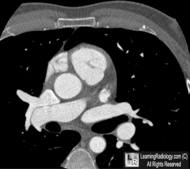 LearningRadiology - atrial, septal, defect, asd