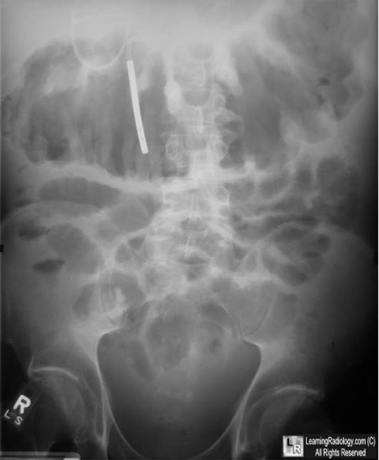 LearningRadiology - Toxic, Megacolon, Colitis, dilated, colon ...