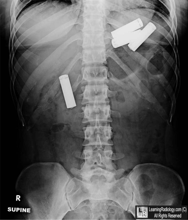 LearningRadiology - battery, ingestion, aa, aaa, esophagus, caustic ...