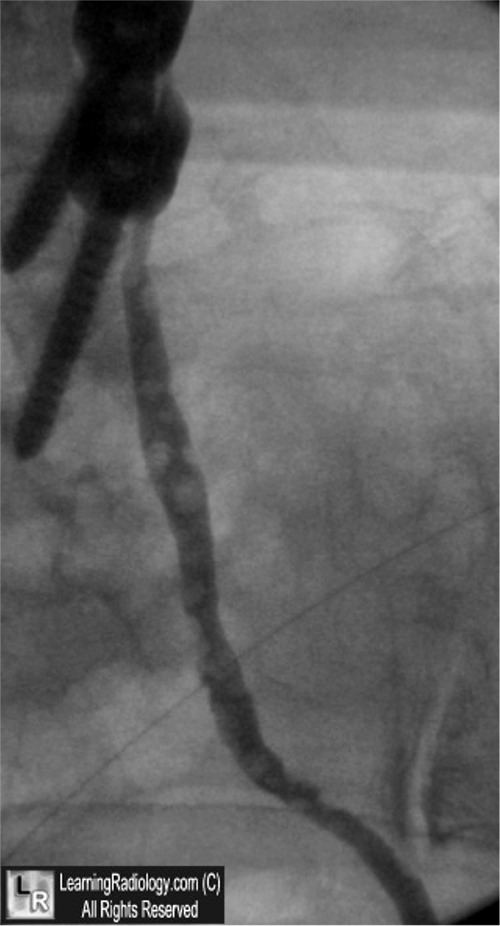 LearningRadiology - Ureteritis, Cystica, ureter, ureteral, irregular ...