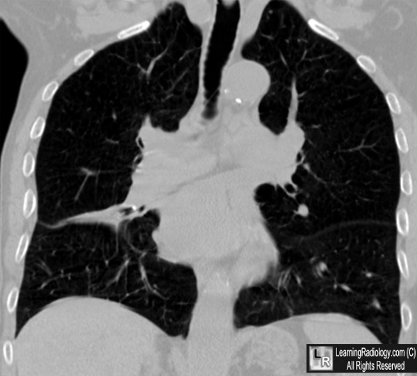LearningRadiology - Broncholithiasis, Broncholiths, bronchial, stone ...