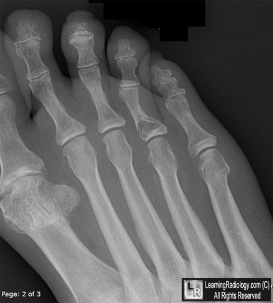 LearningRadiology - enchondroma, benign, expansile, bone, tumor, finger ...