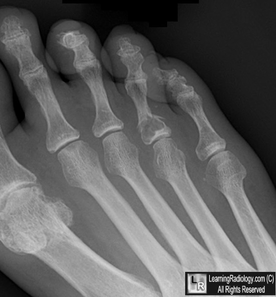 LearningRadiology- Enchondroma