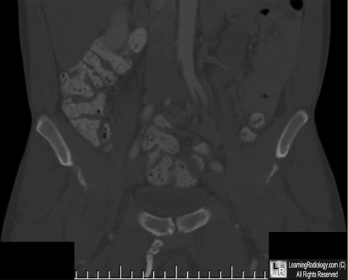 LearningRadiology - pelvic, pelvis, rib, digit, finger, radiology
