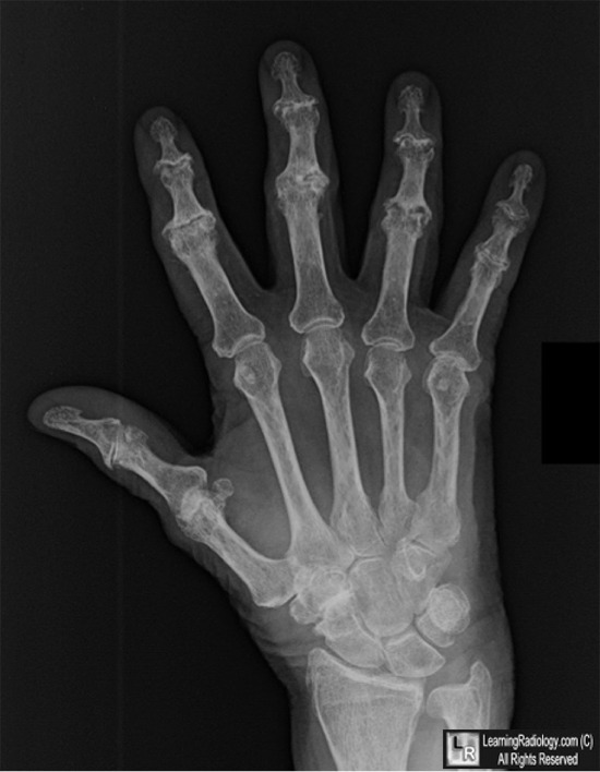 LearningRadiology - erosive, osteoarthritis, inflammatory, arthritis, hand