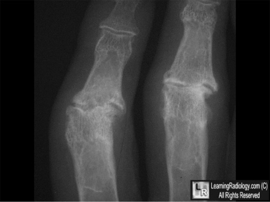 LearningRadiology - erosive, osteoarthritis, inflammatory, arthritis ...
